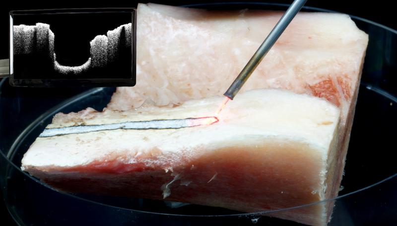 Laser and OCT Innovations Simplify Spinal Canal Surgery - Innovations ...