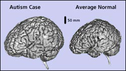 UCSD Study Links Early Brain Growth to Autism Development - Innovations ...